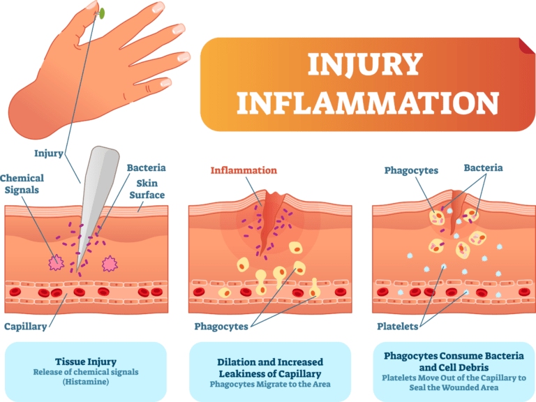 Inflamación: tipos y patologías asociadas - MiSistemaInmune